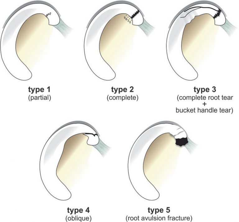 Type meniscusletsels