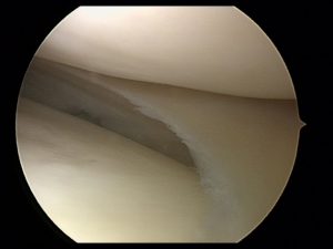De normale meniscus