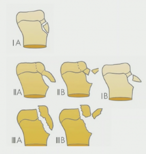VKB-ruptuur bij Kinderen