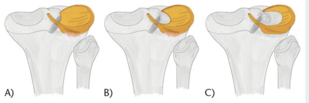 Discoide meniscus
