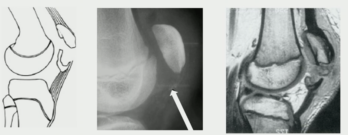 VKB-ruptuur bij Kinderen