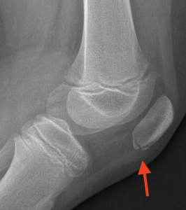 VKB-ruptuur bij Kinderen